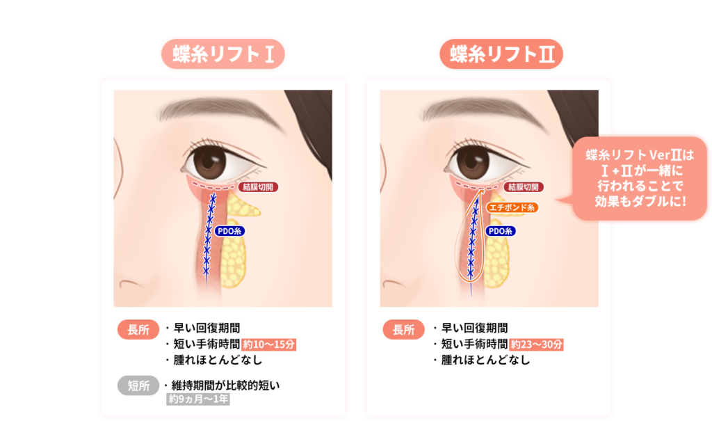 蝶糸リフト Ⅰ,Ⅱ ＆ Soof lifting | オンユ美容整形外科